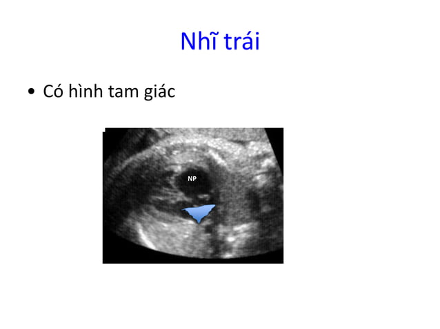 5. Sieu am tim thai binh thuong, GS Michel Collet | PDF