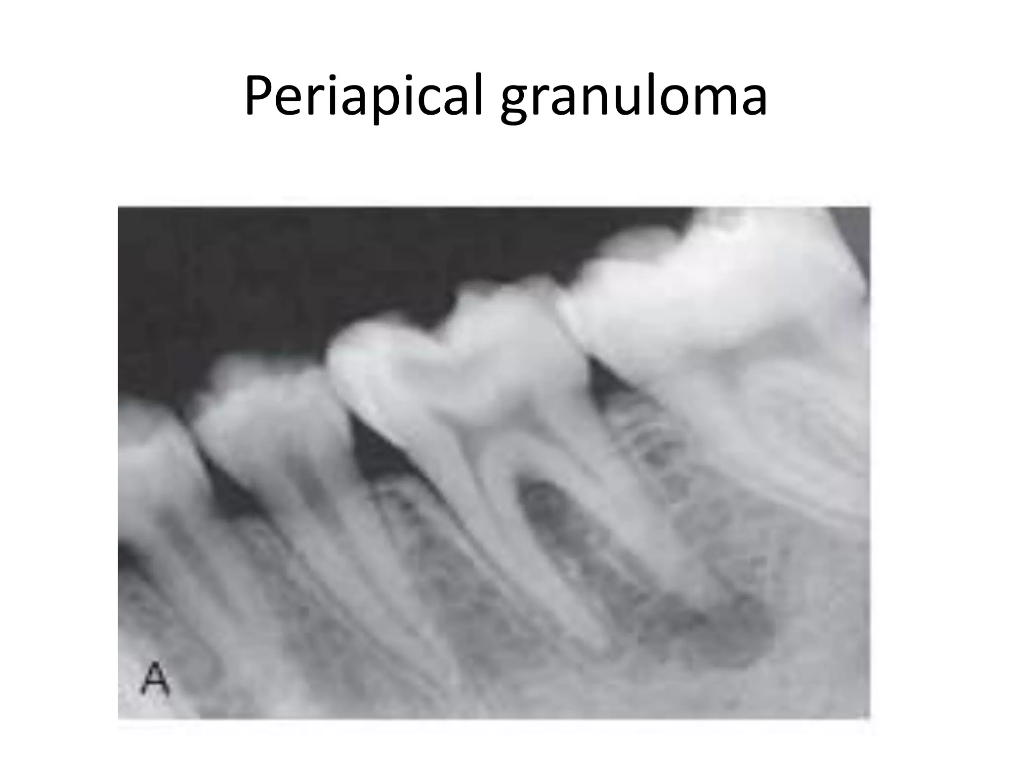 Periapical radiolucencies | PPTX