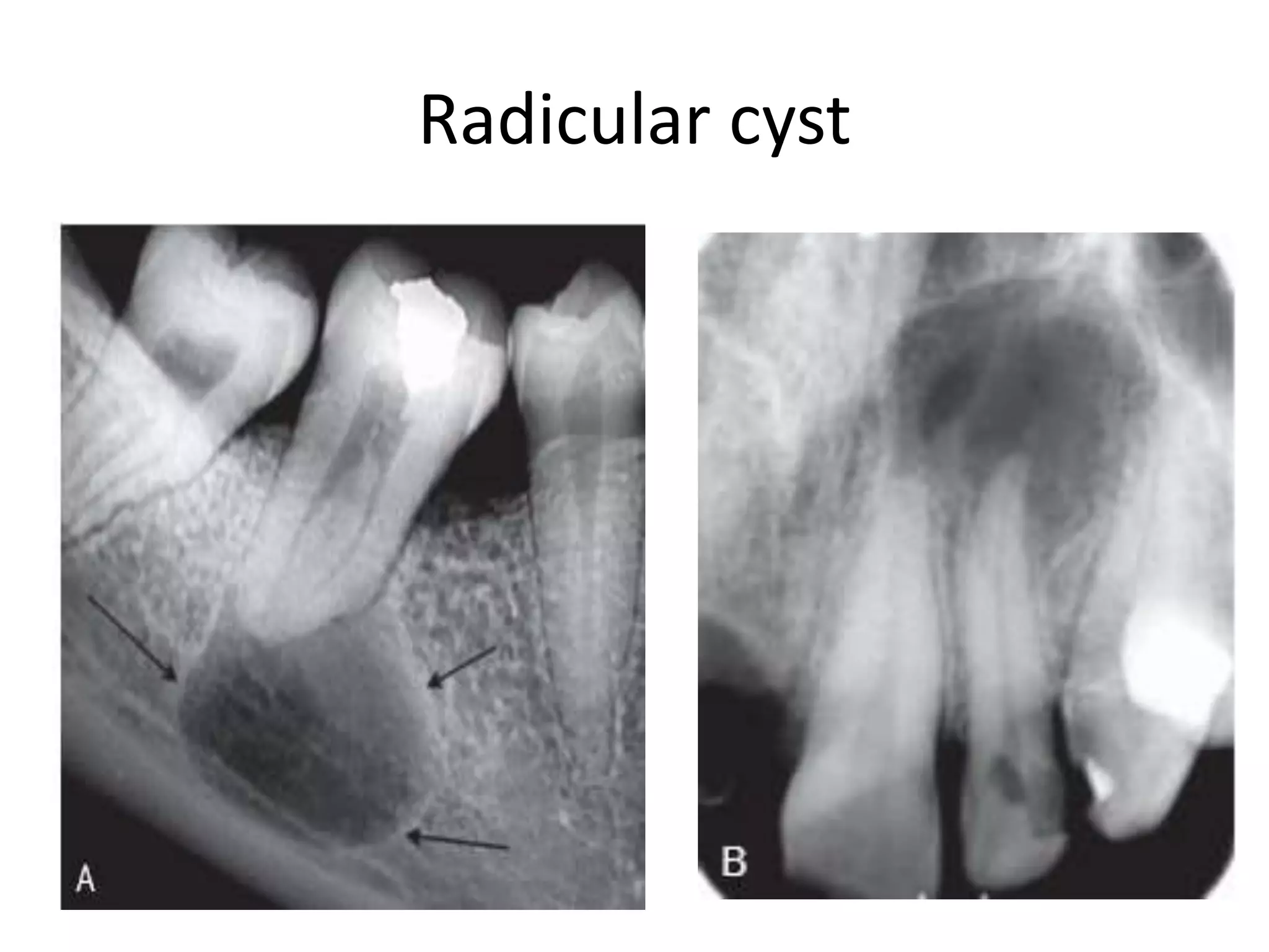 Periapical radiolucencies | PPTX