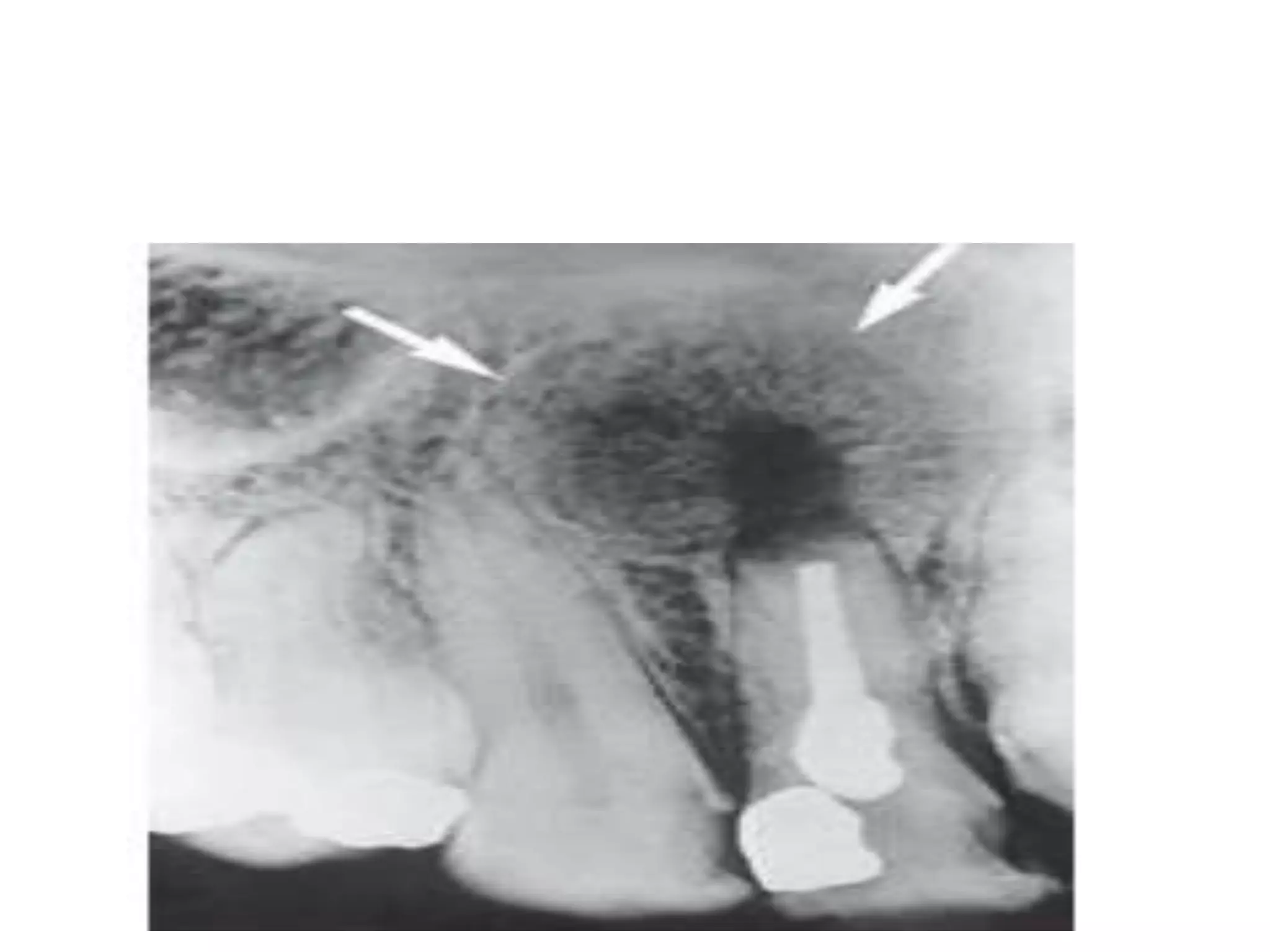 Periapical radiolucencies | PPTX