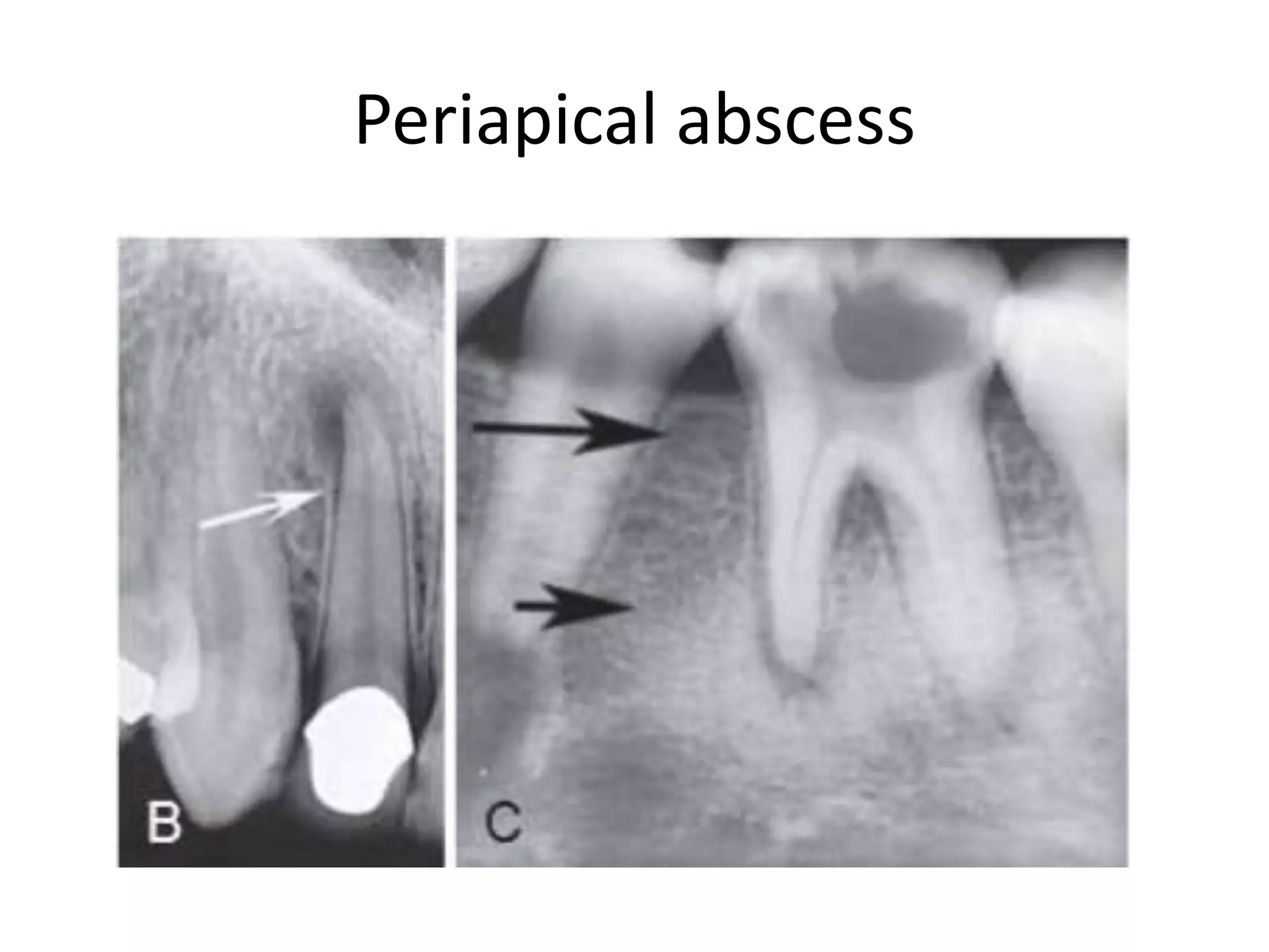 Periapical radiolucencies | PPTX