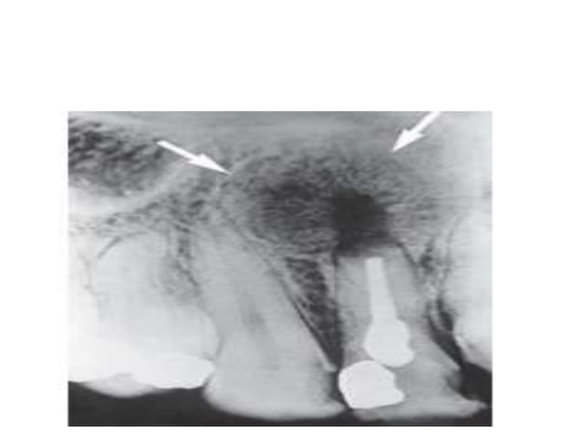 Periapical radiolucencies | PPTX | Dental Health | Diseases and Conditions