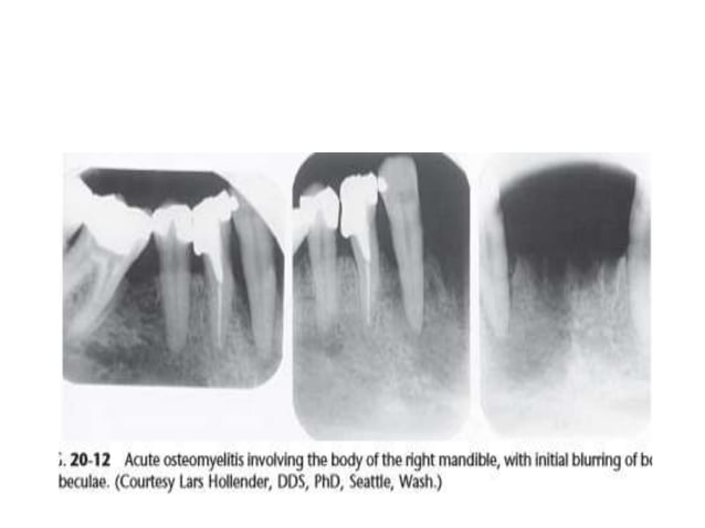Periapical radiolucencies | PPTX | Dental Health | Diseases and Conditions