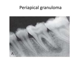 Periapical Radiolucency