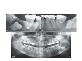 Radiolucent Rarefying Osteitis