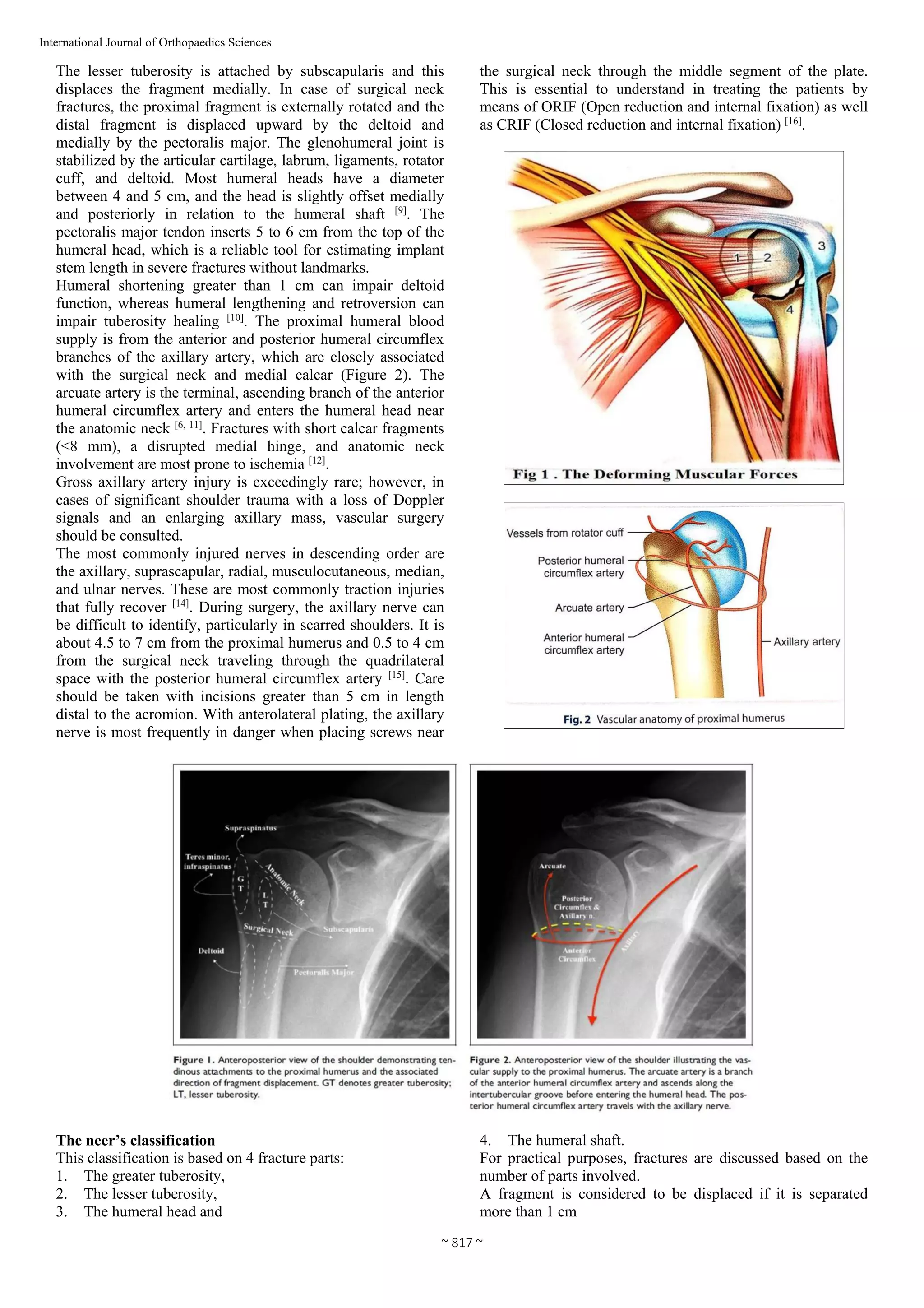 Proximal Humerus Fractures | PDF