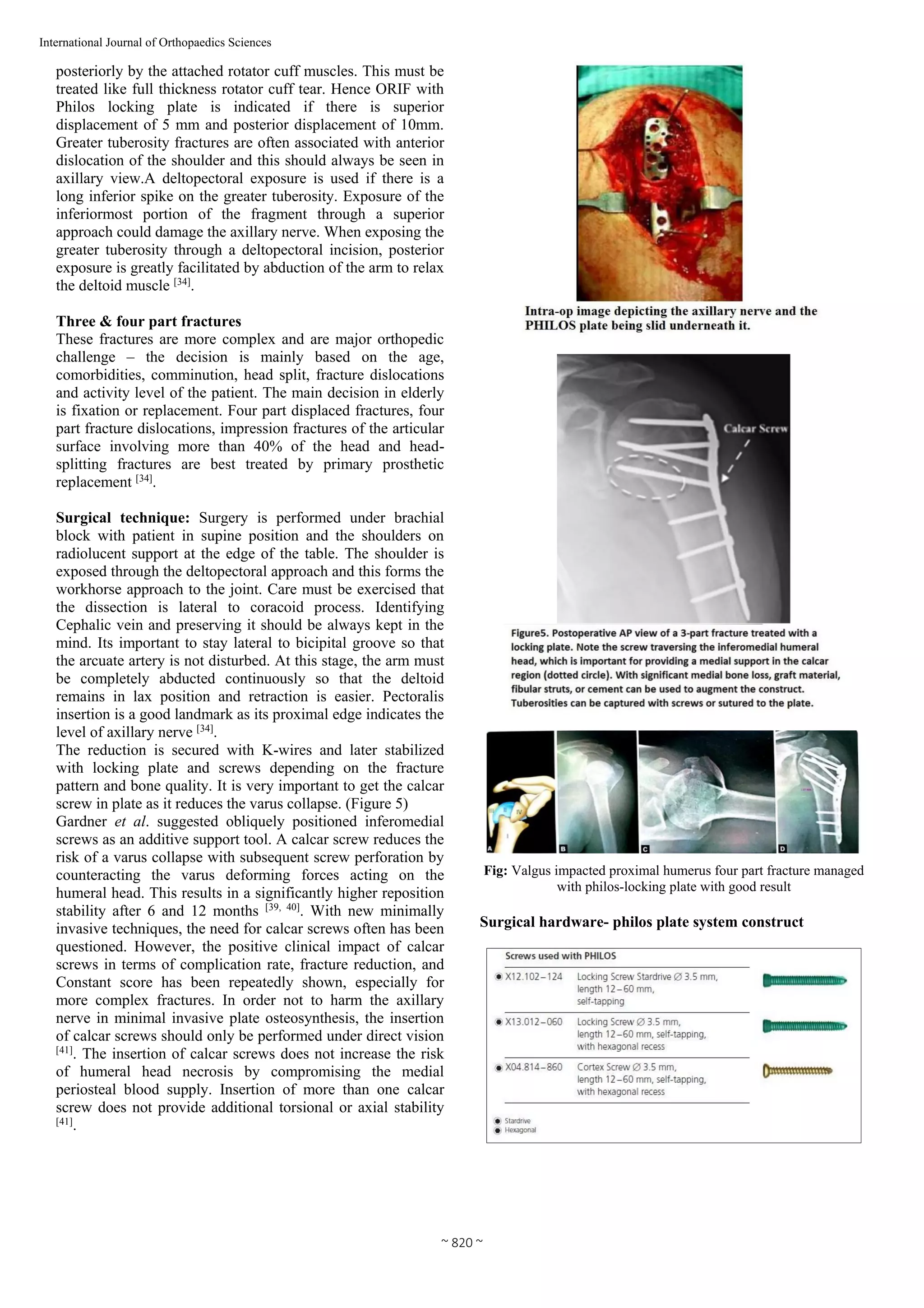 Proximal Humerus Fractures | PDF