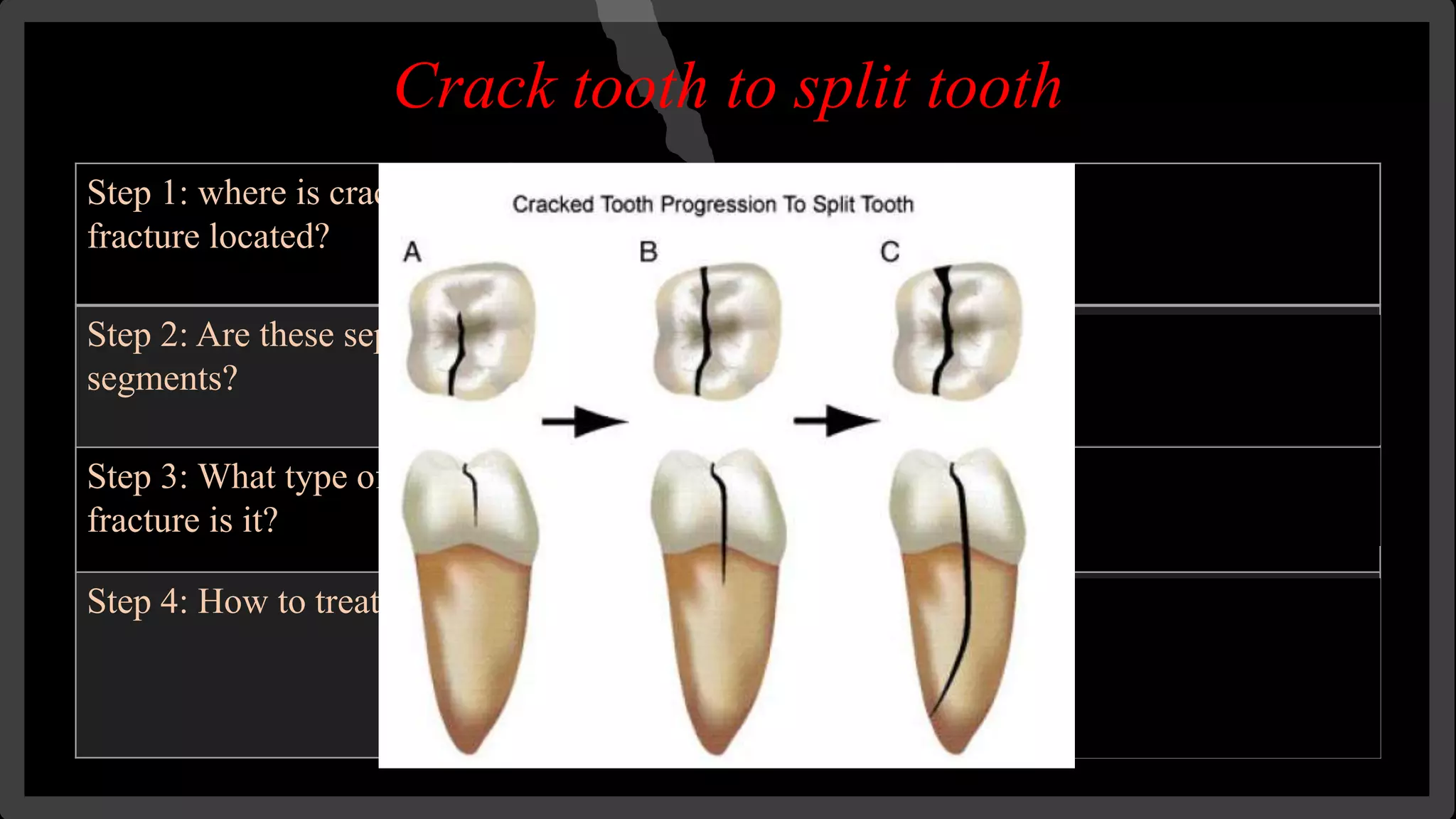 Management of Tooth fracture | PPTX