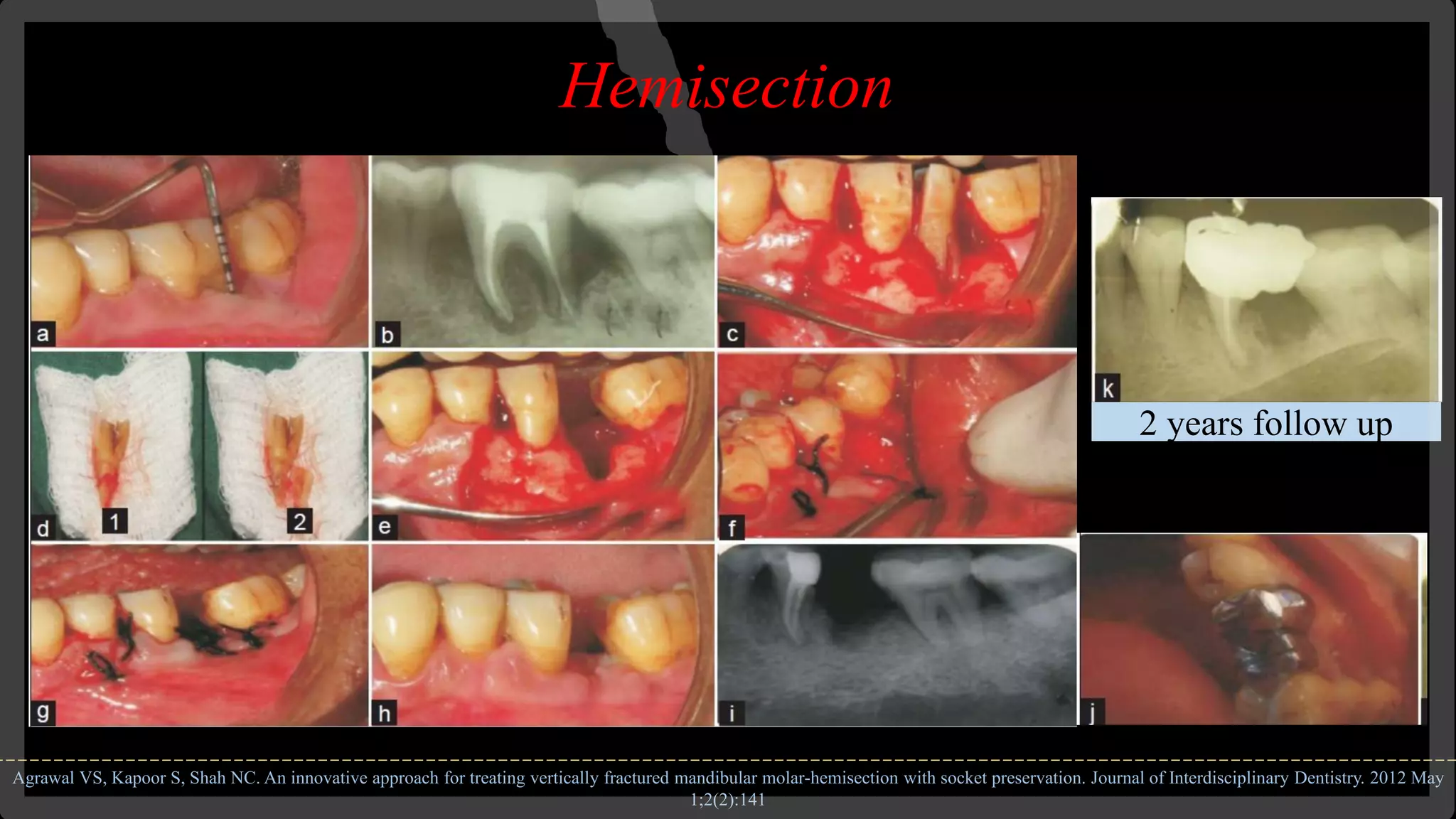 Management of Tooth fracture | PPTX