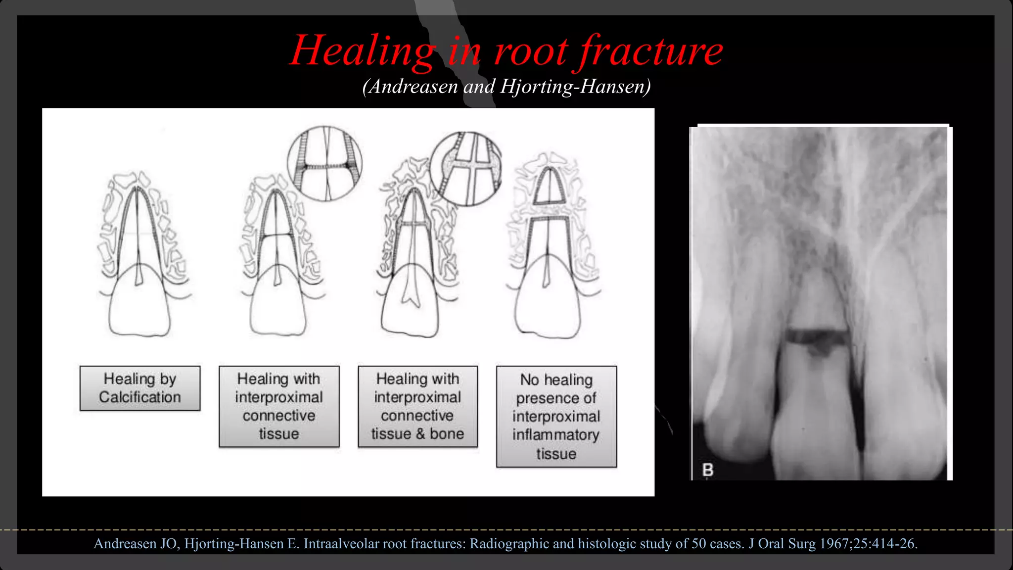 Management of Tooth fracture | PPTX