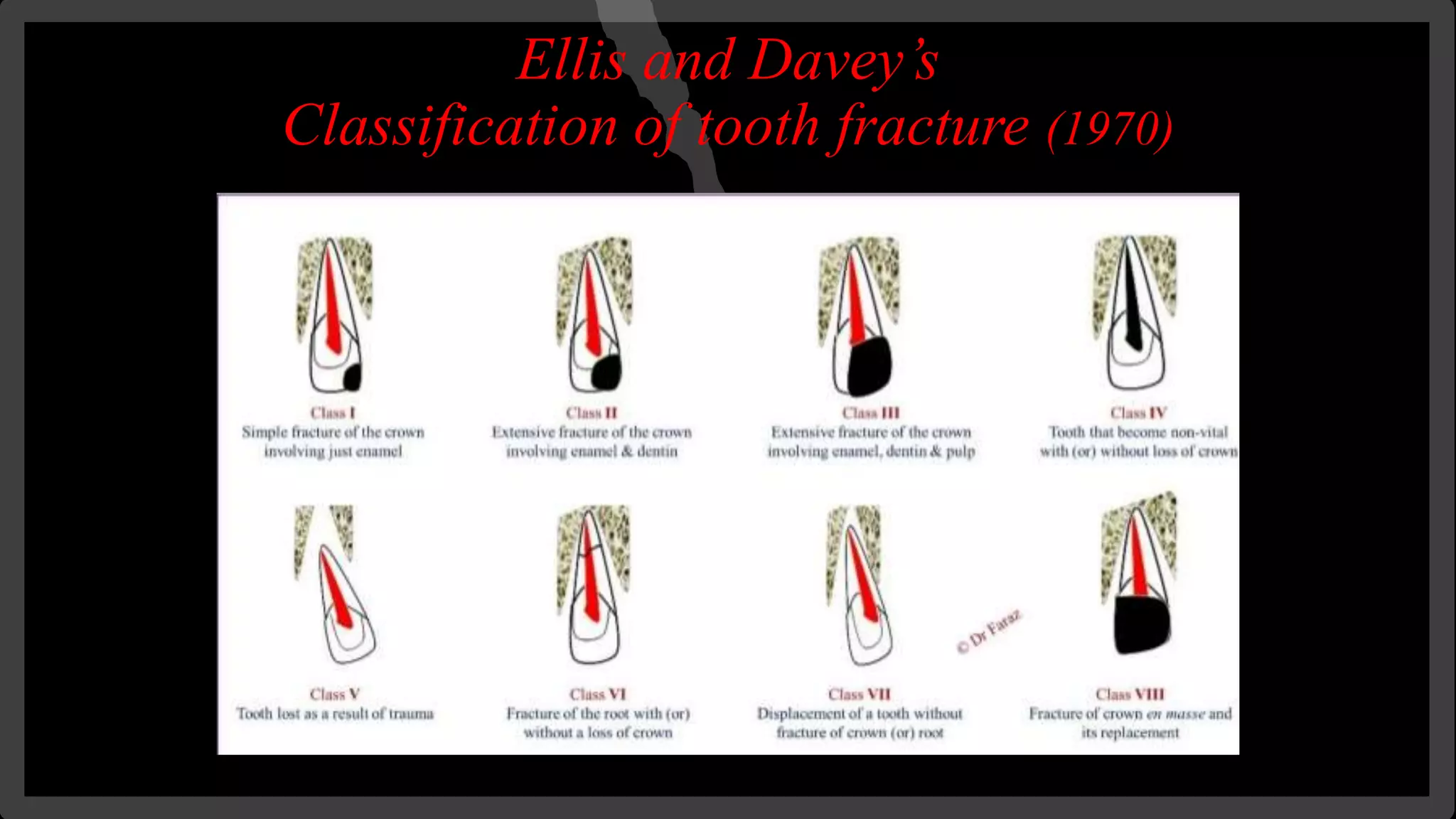 Management of Tooth fracture | PPTX