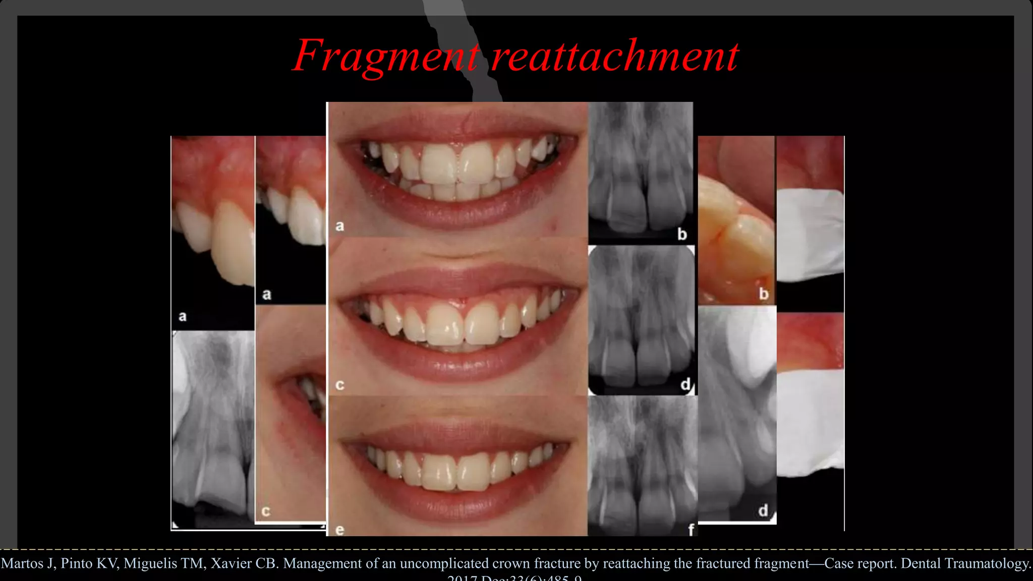Management of Tooth fracture | PPTX