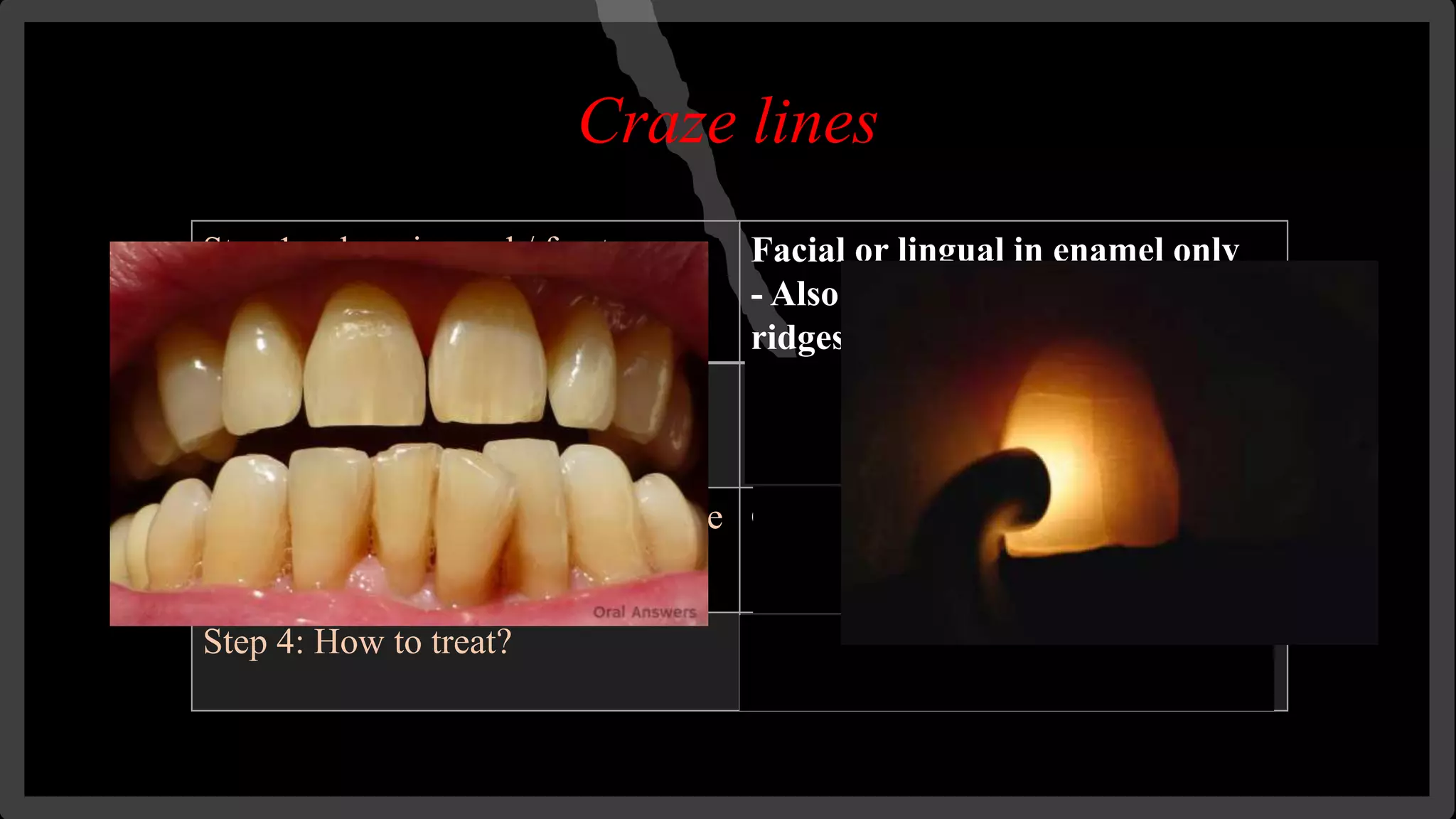 Management of Tooth fracture | PPTX