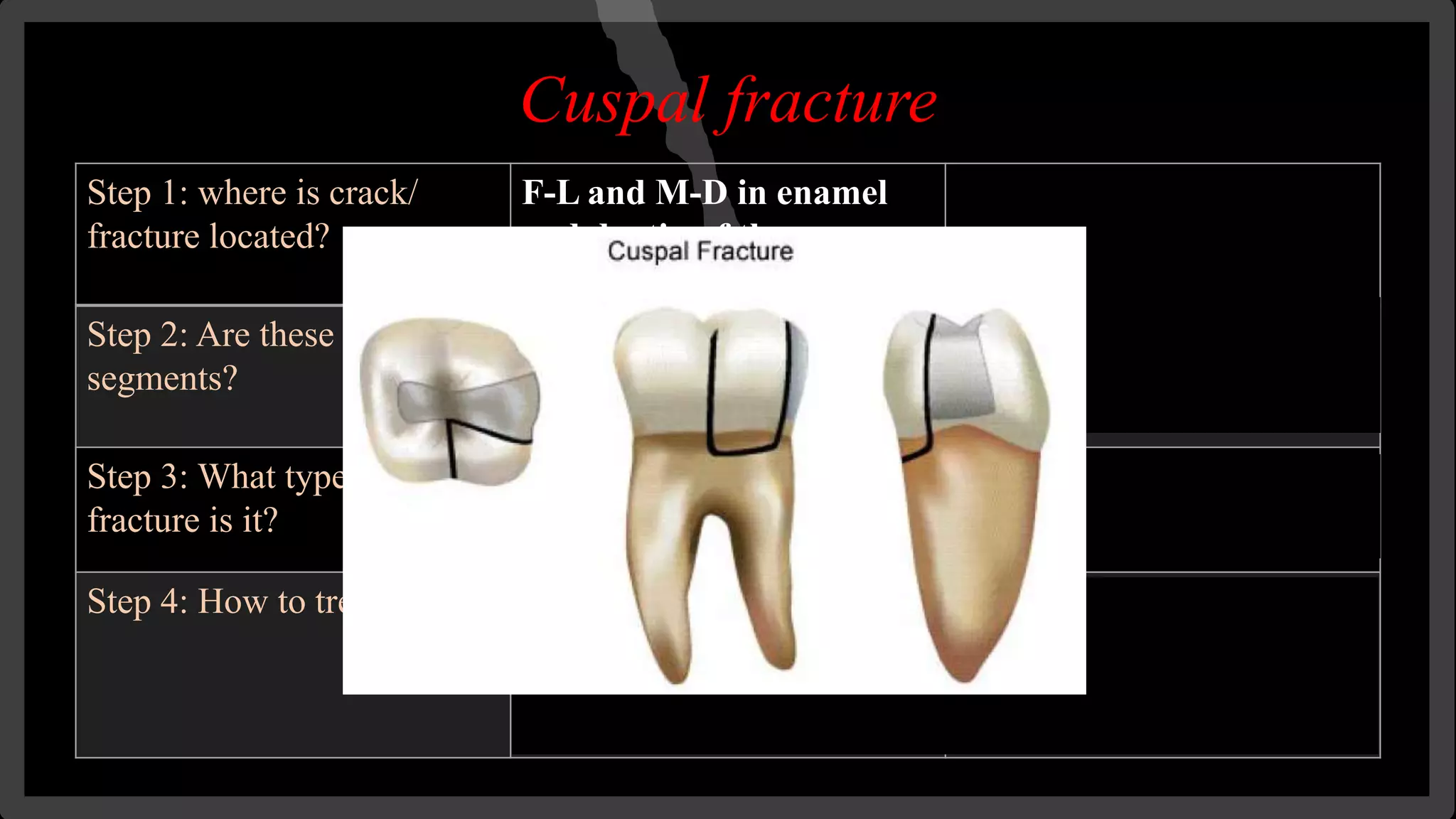 Management of Tooth fracture | PPTX