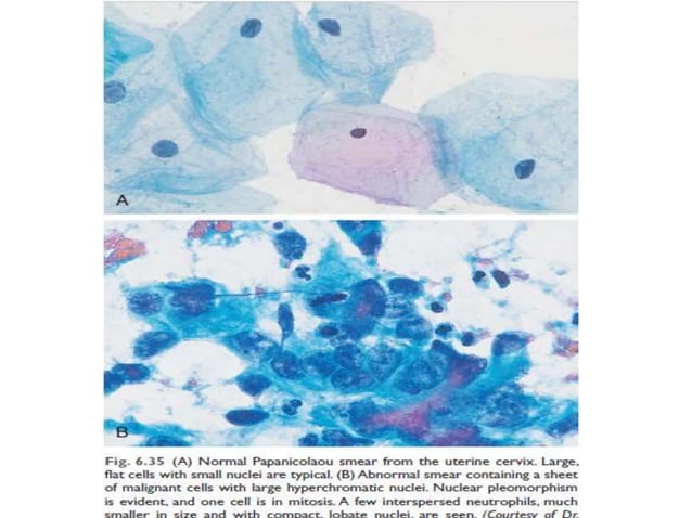 lab diagnosis of neoplasm or tumours | PPTX | Cancer | Diseases and ...