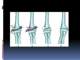 5. Supra Condylar fracture of Humerus | PPTX