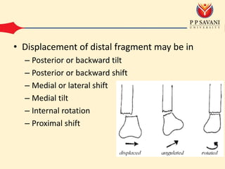 5. Supra Condylar fracture of Humerus | PPTX