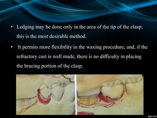 Lab procedures in fabrication of CPD- Dr Prathibha | PPTX