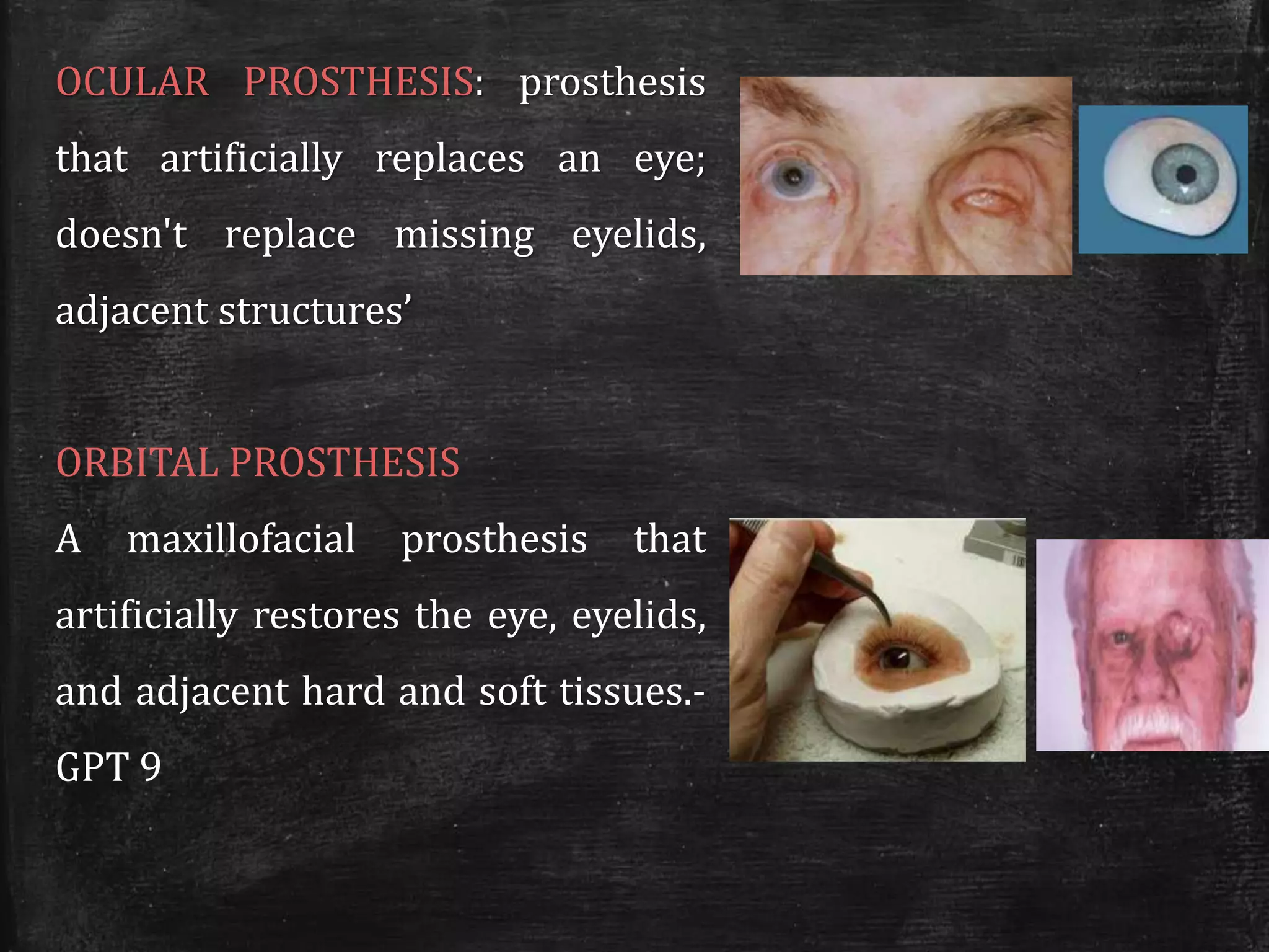 Ocular and Orbital prosthesis ANJALI RATHORE | PPTX