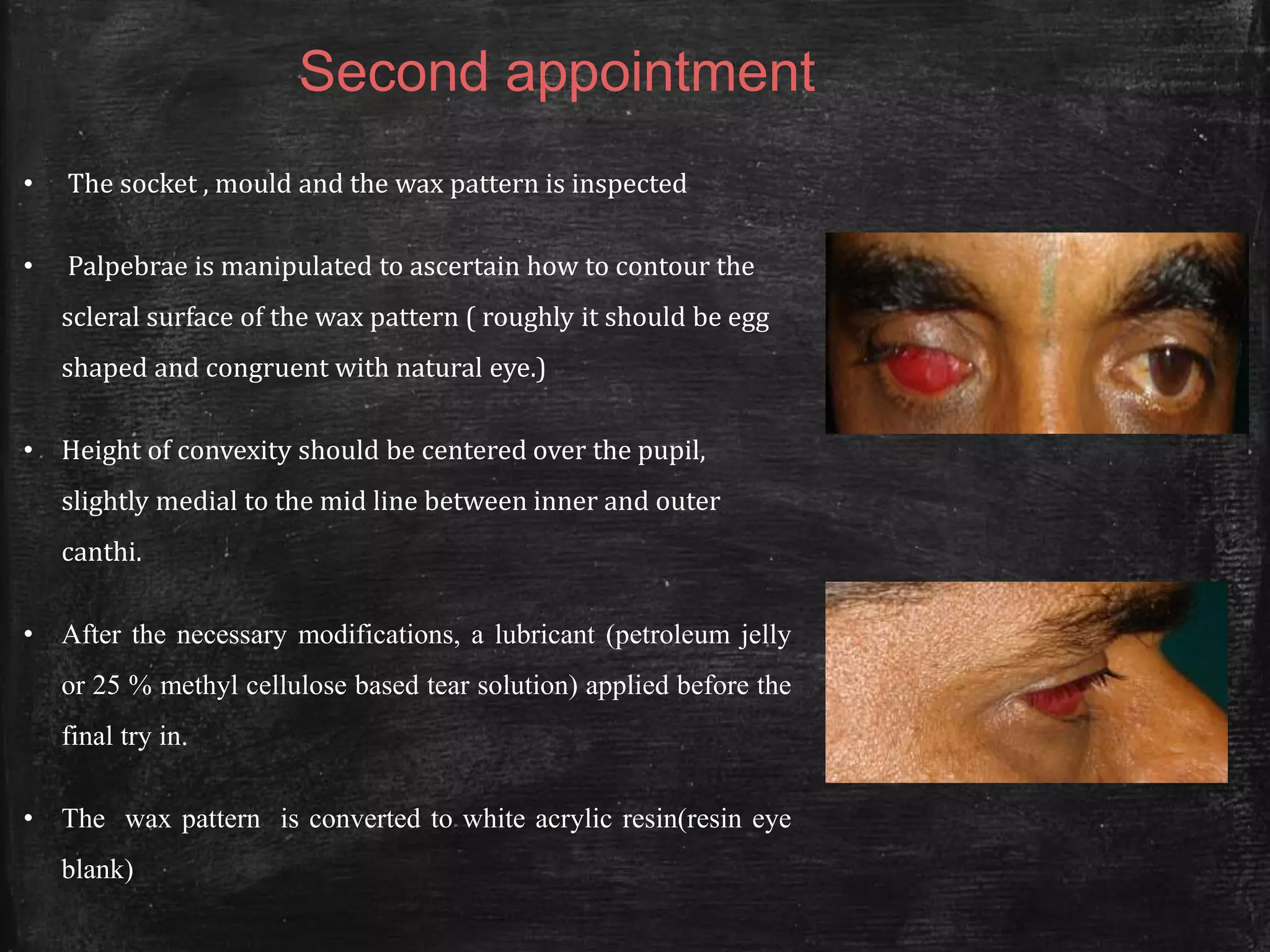 Ocular and Orbital prosthesis ANJALI RATHORE | PPTX