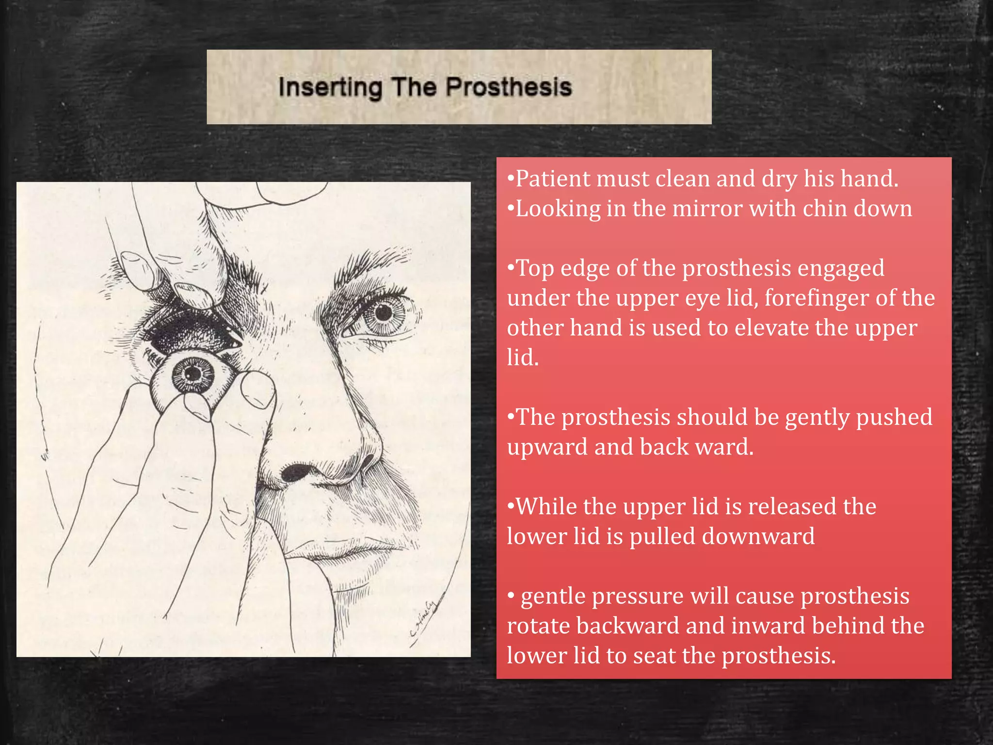 Ocular and Orbital prosthesis ANJALI RATHORE | PPTX