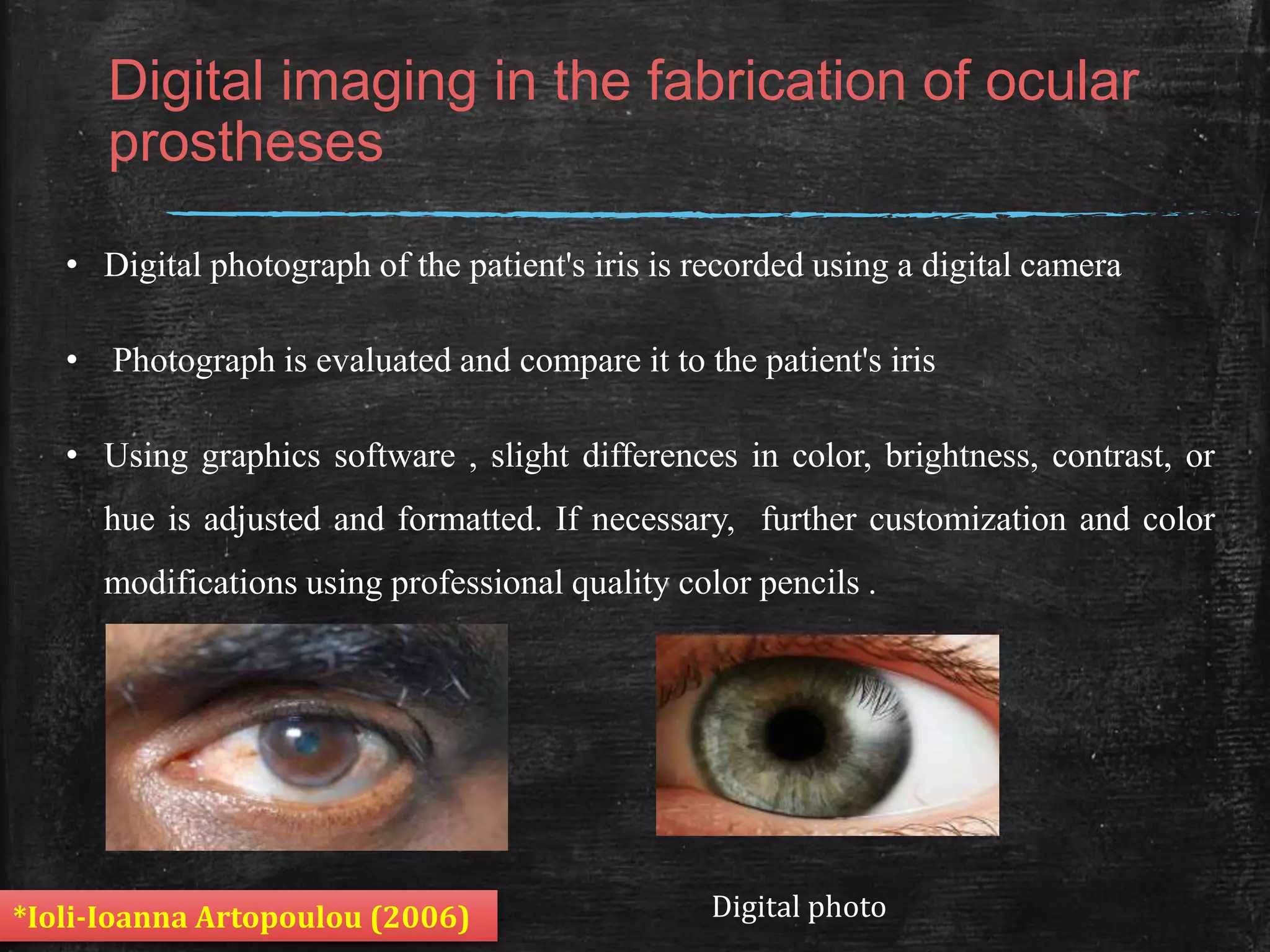 Ocular and Orbital prosthesis ANJALI RATHORE | PPTX