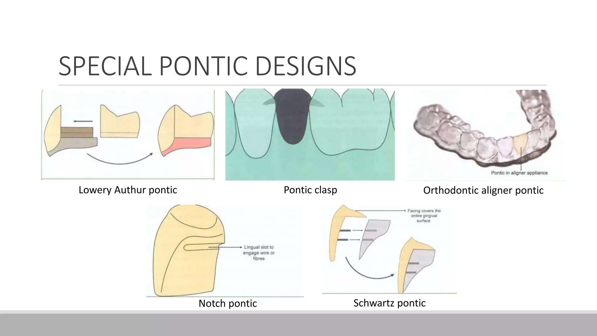 COMPONENTS OF FIXED PARTIAL DENTURE | PPTX