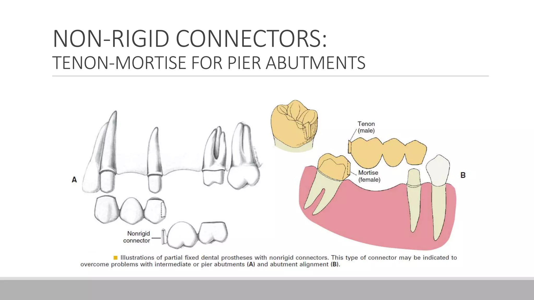 COMPONENTS OF FIXED PARTIAL DENTURE | PPTX