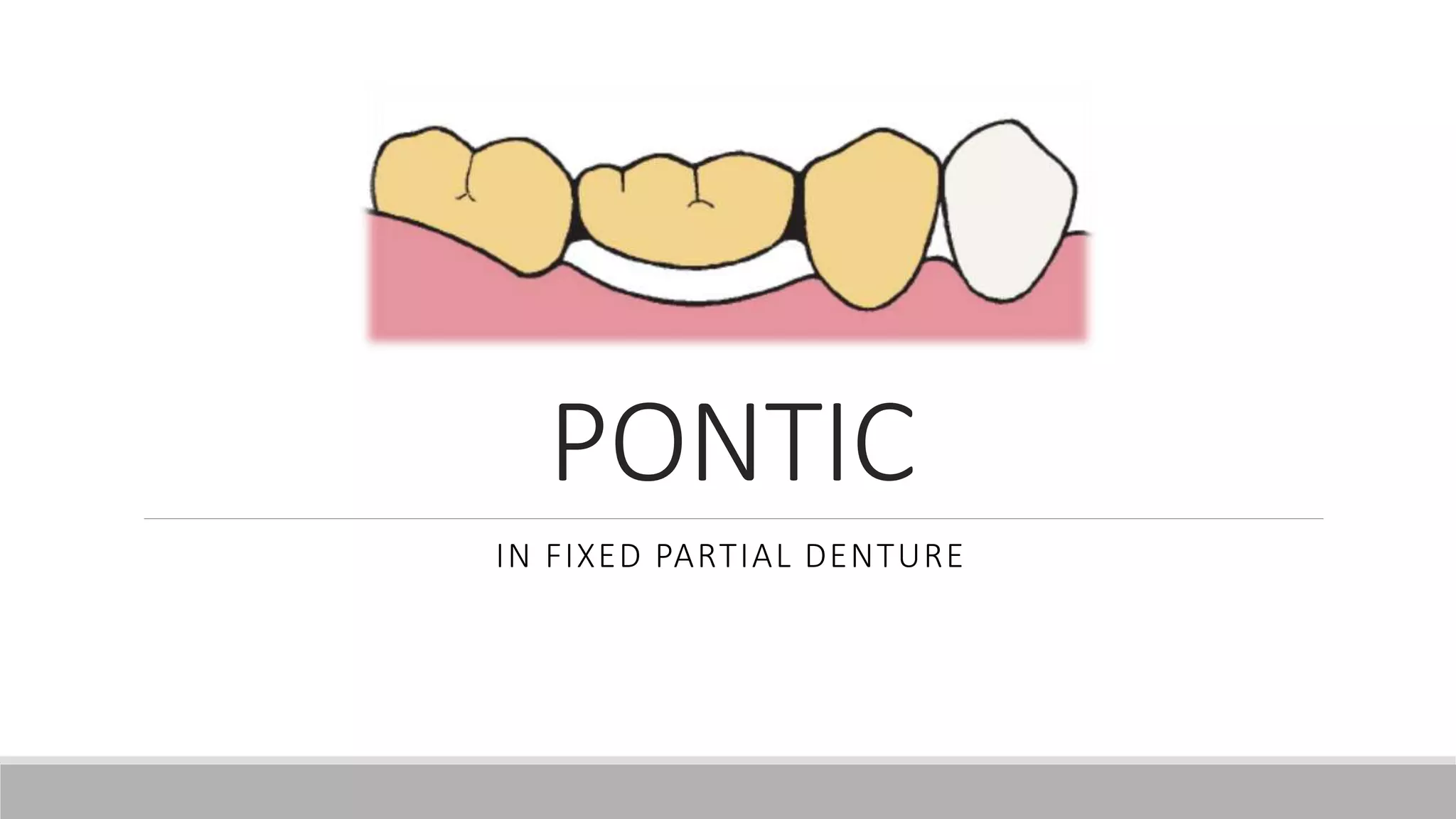 COMPONENTS OF FIXED PARTIAL DENTURE | PPTX