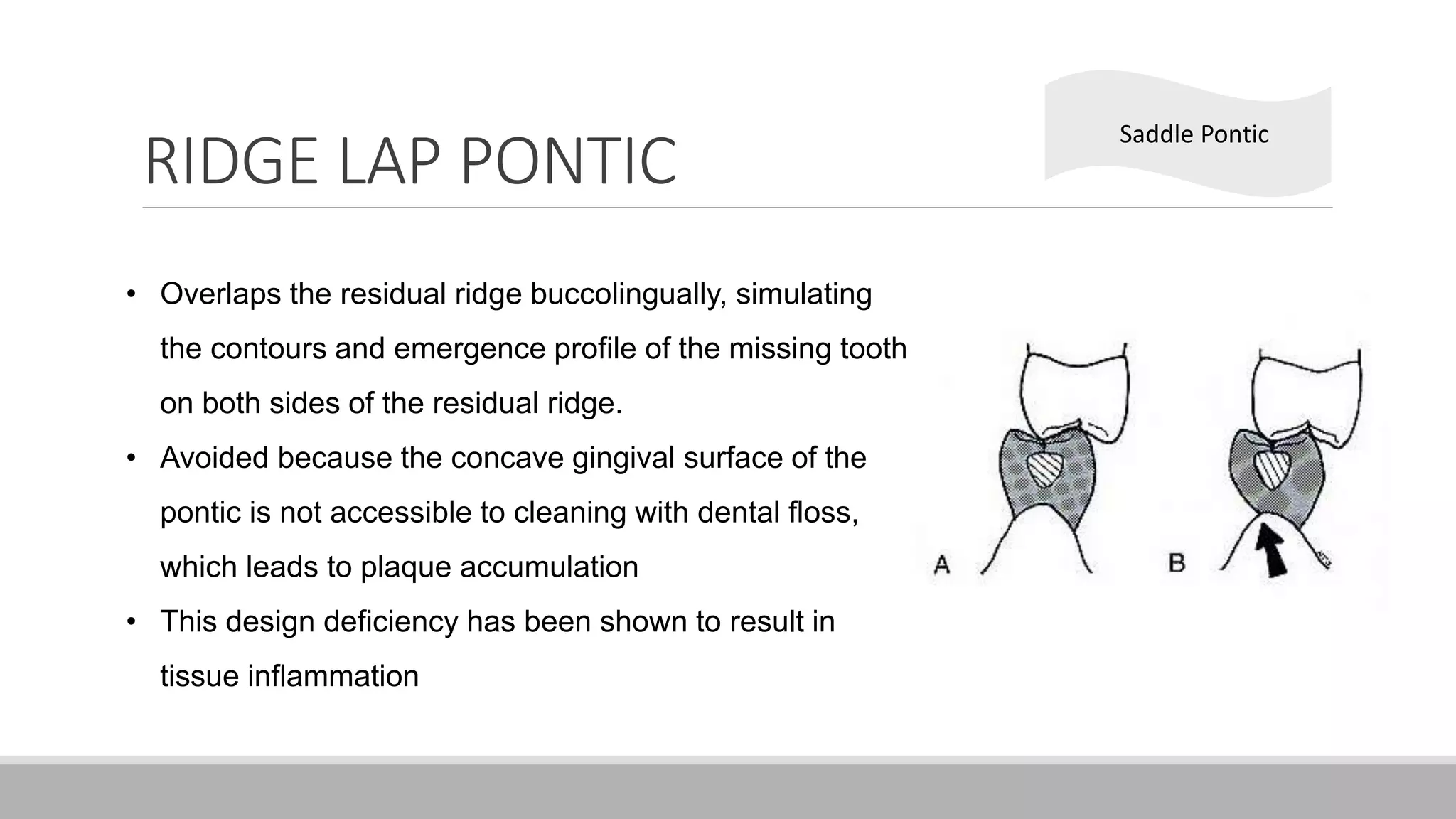 COMPONENTS OF FIXED PARTIAL DENTURE | PPTX