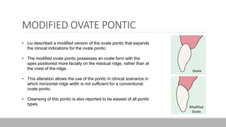 COMPONENTS OF FIXED PARTIAL DENTURE | PPTX