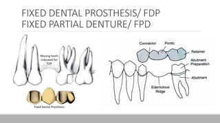 COMPONENTS OF FIXED PARTIAL DENTURE | PPTX | Dental Health | Diseases ...