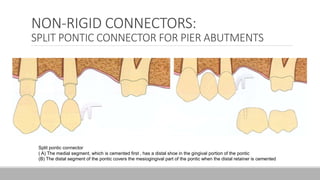 COMPONENTS OF FIXED PARTIAL DENTURE | PPTX