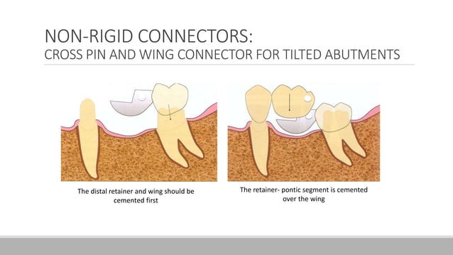 COMPONENTS OF FIXED PARTIAL DENTURE | PPTX | Dental Health | Diseases ...