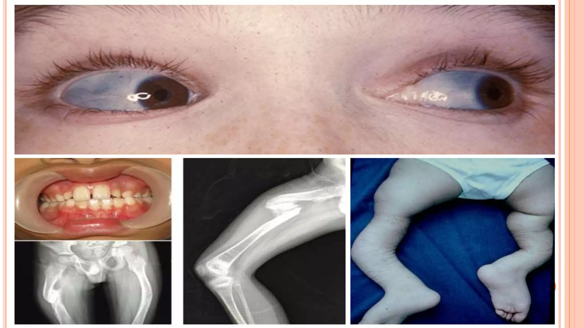 Osteogenesis imperfecta | PPTX