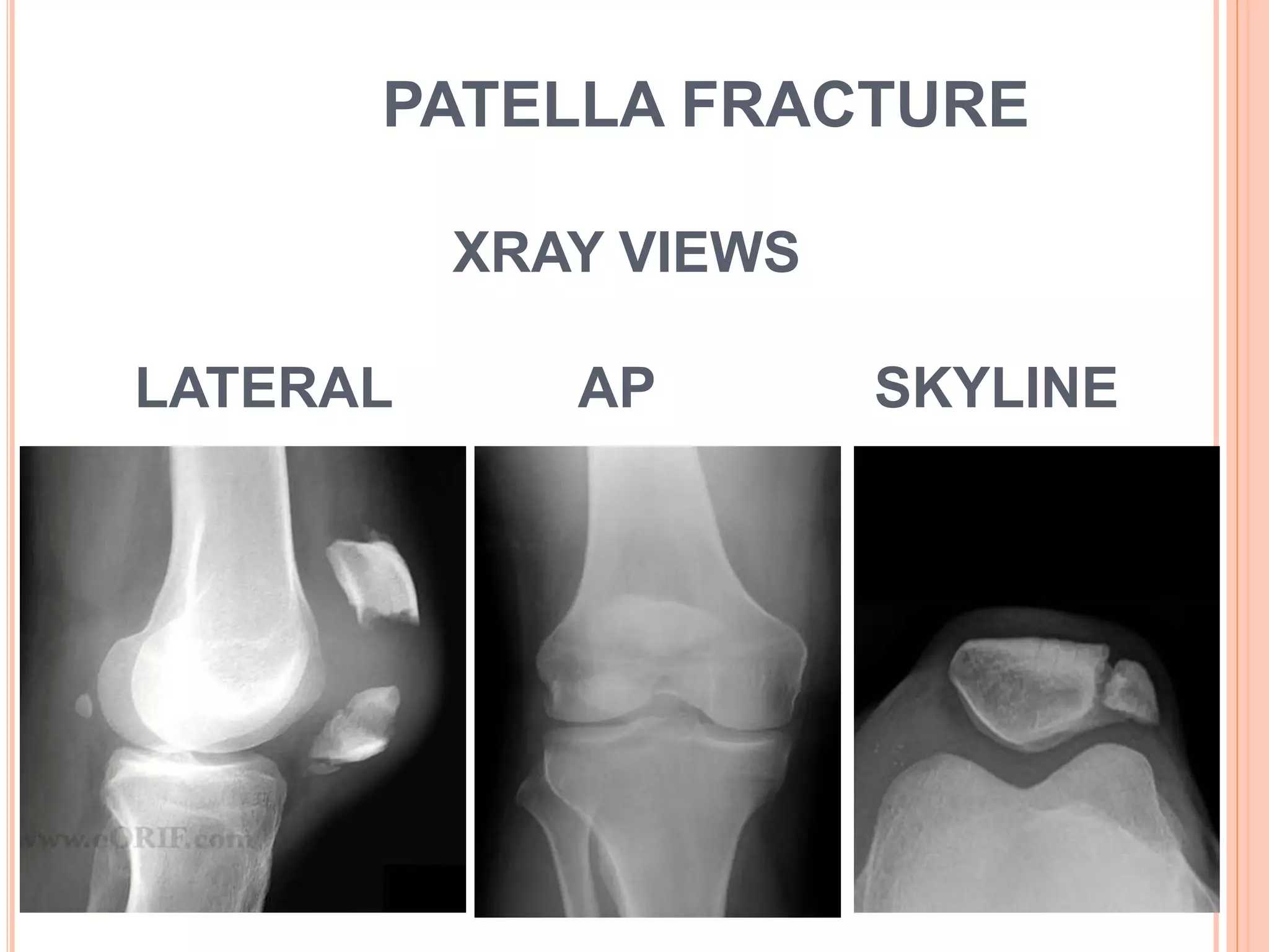 Patella | PPTX
