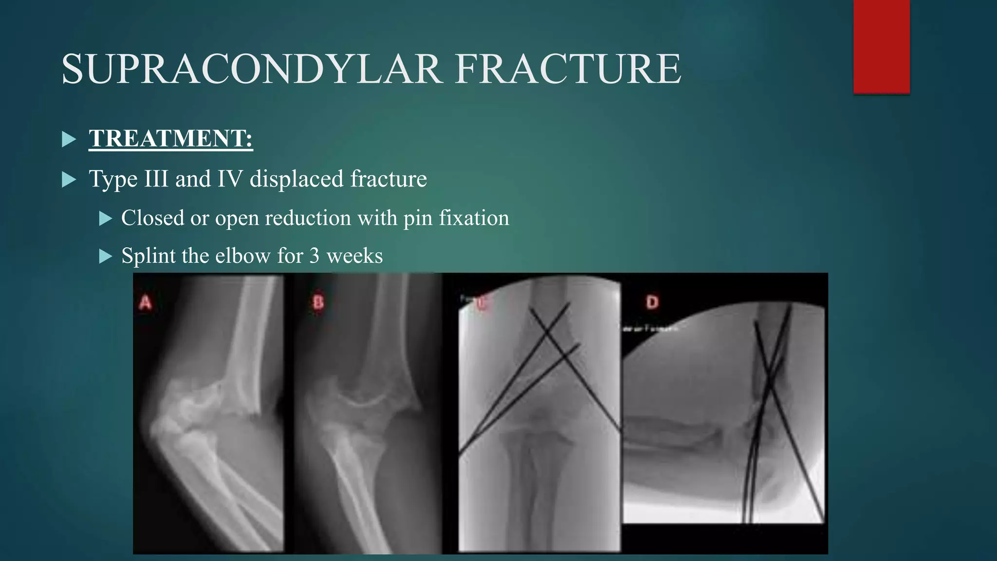 Supracondylar fracture of humerus | PPTX