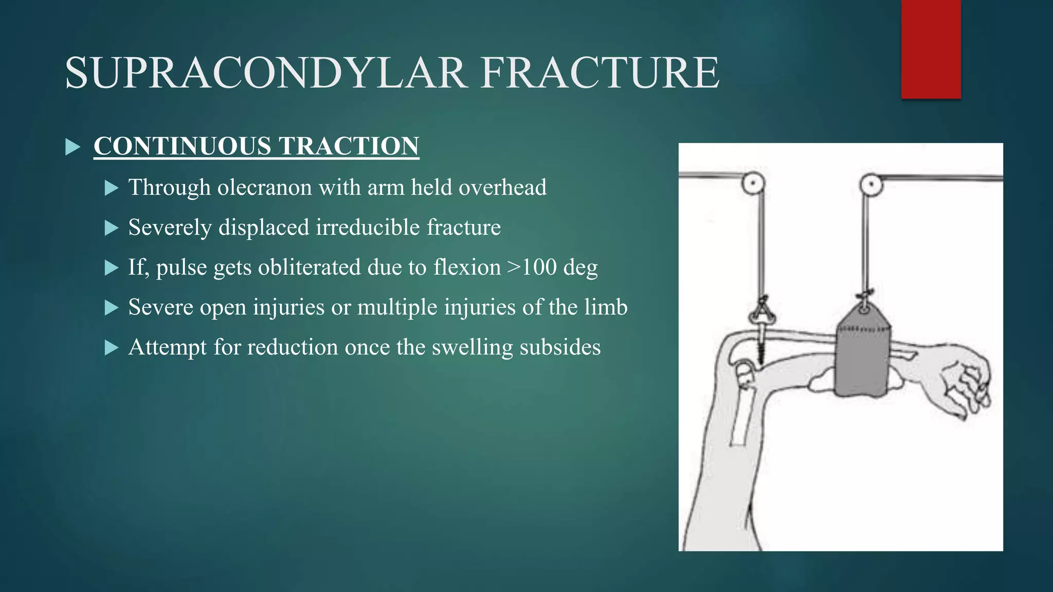 Supracondylar fracture of humerus | PPTX