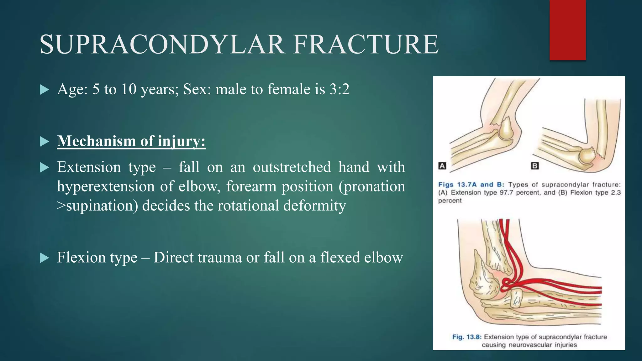 Supracondylar fracture of humerus | PPTX