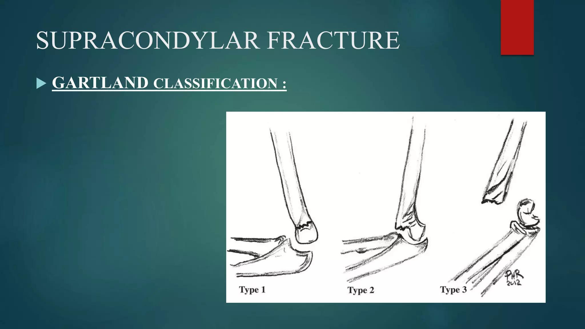 Supracondylar fracture of humerus | PPTX