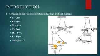 Supracondylar fracture of humerus | PPTX