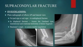 Supracondylar Humerus Fracture
