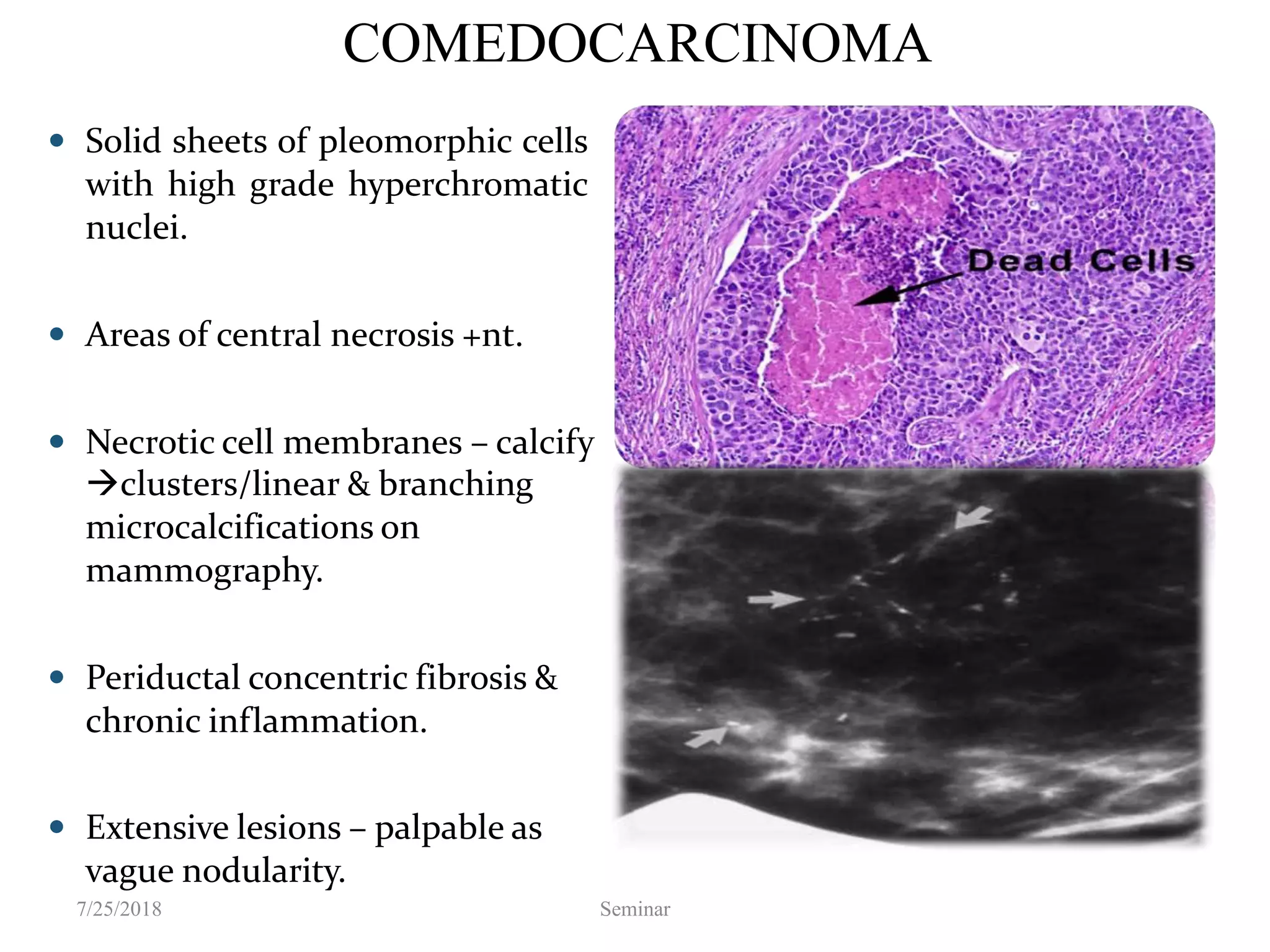 5. breast carcinoma histopathology types and clinical features | PPTX