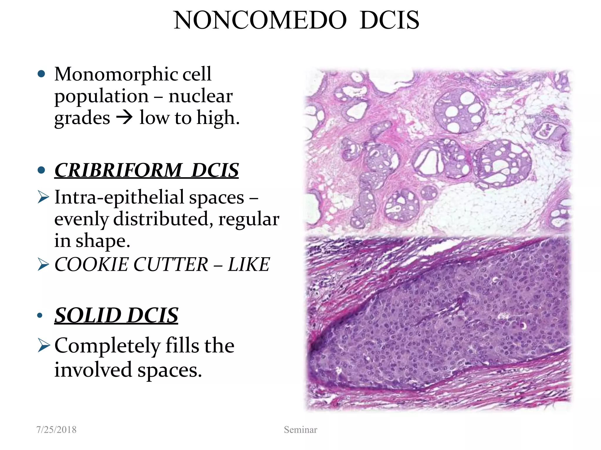 5. breast carcinoma histopathology types and clinical features | PPTX