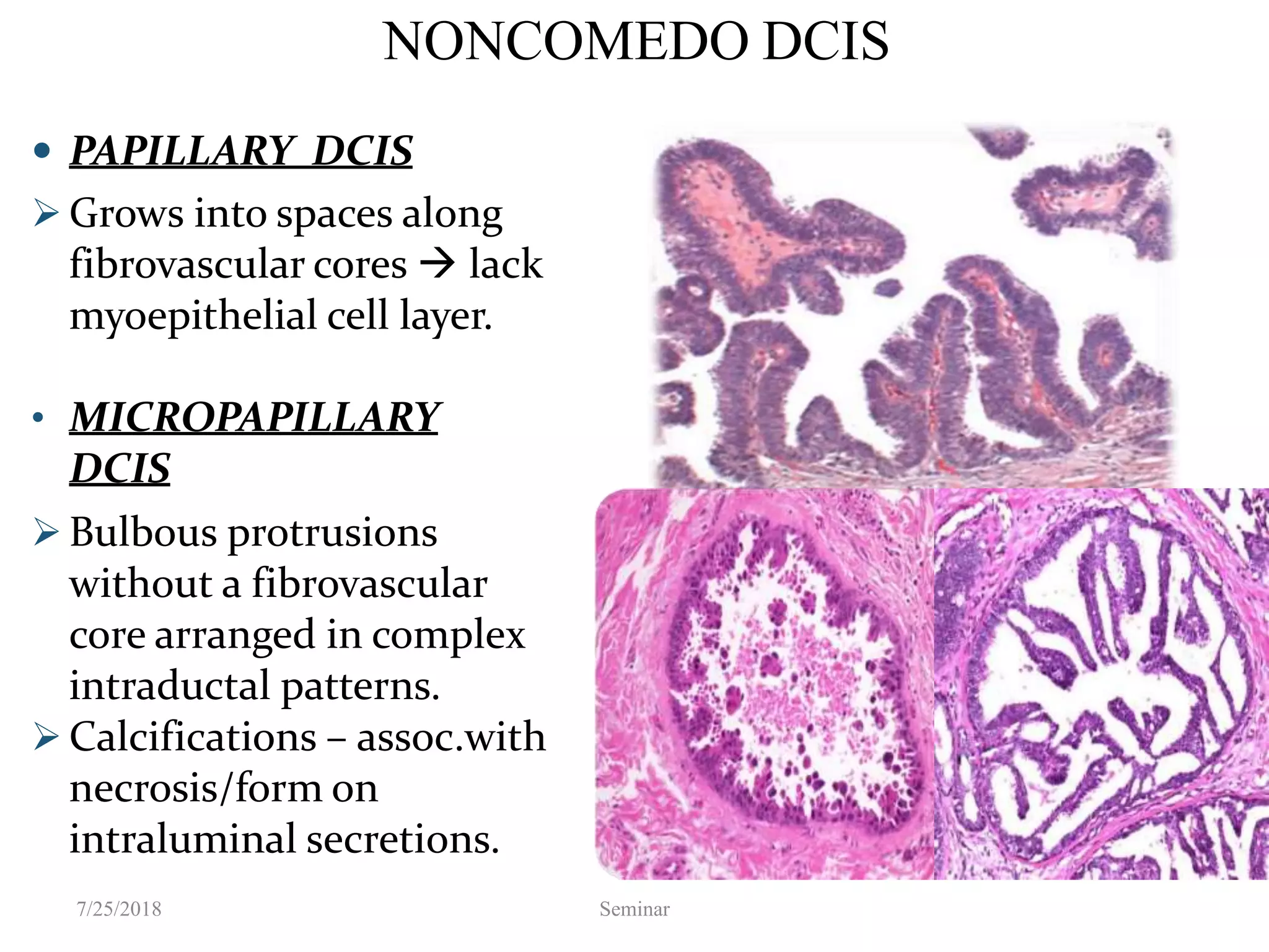 5. breast carcinoma histopathology types and clinical features | PPTX