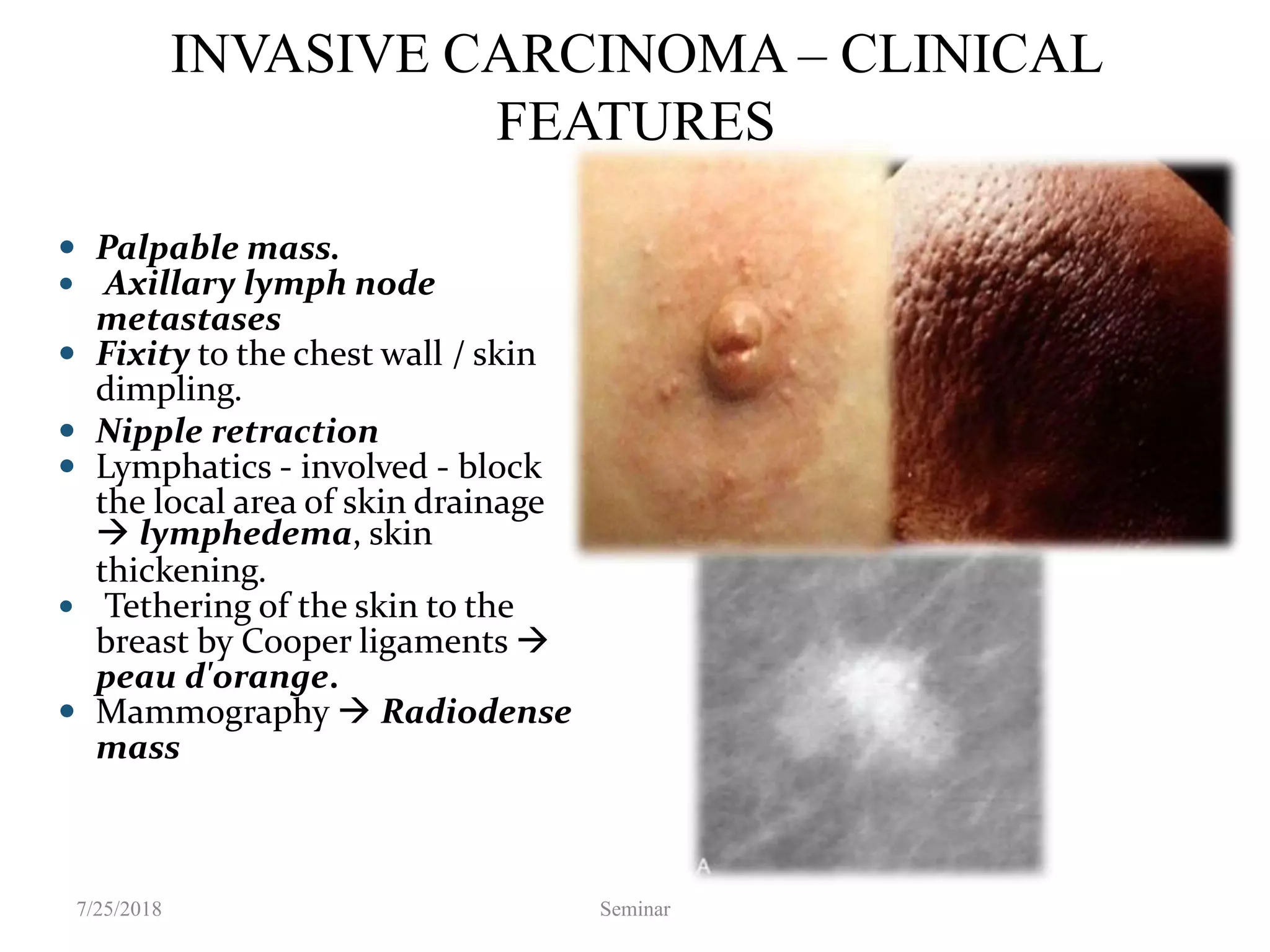 5. breast carcinoma histopathology types and clinical features | PPTX