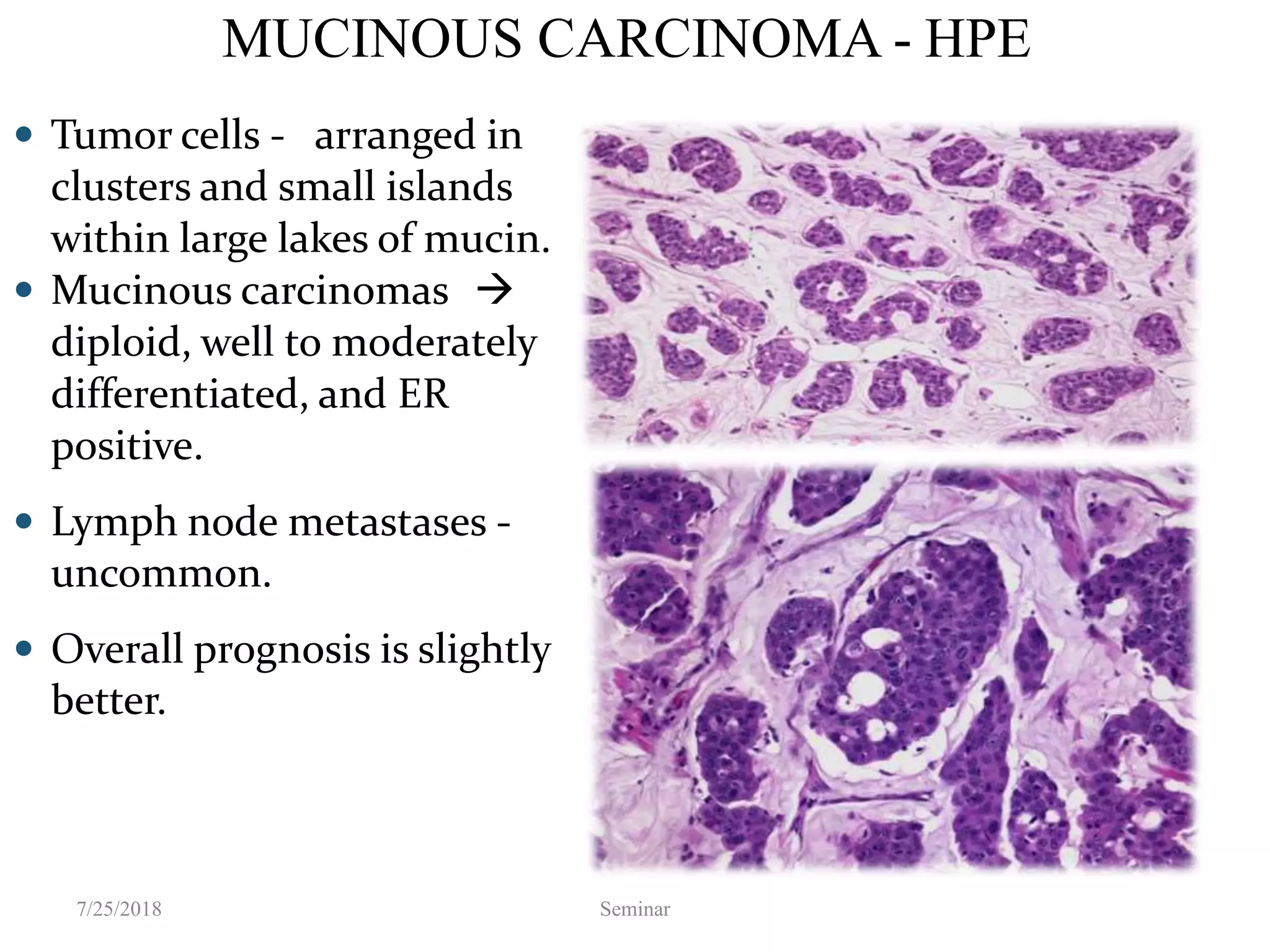 5. breast carcinoma histopathology types and clinical features | PPTX