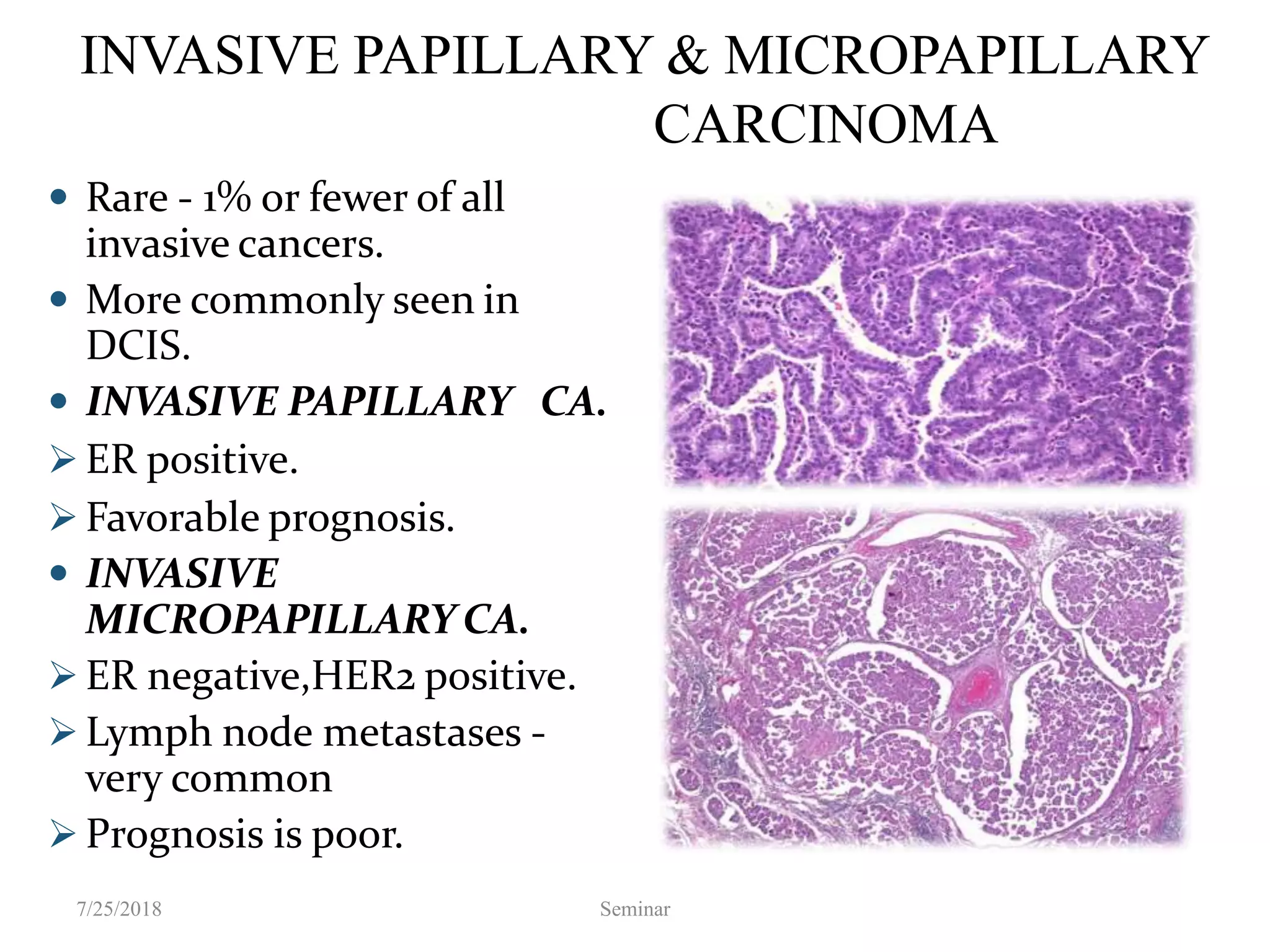 5. breast carcinoma histopathology types and clinical features | PPTX