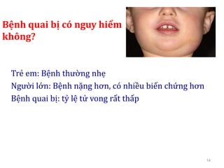 Bệnh quai bị - 2019 - Đại học Y dược TPHCM | PDF