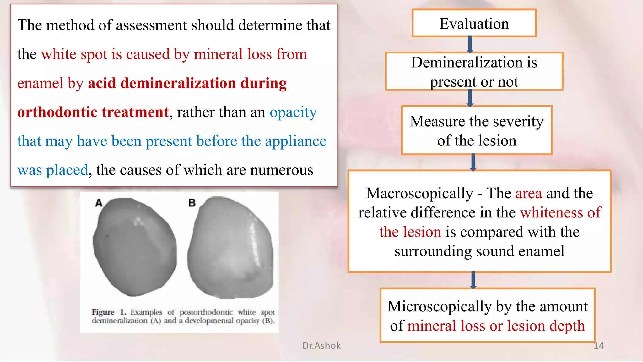 white spot lesion - prevention and management | PPTX